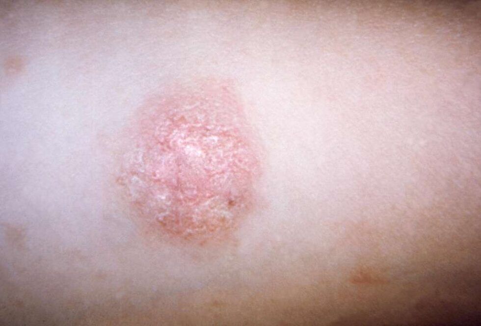 Pityriasis Rosea: What Is It and How Can It Be Treated? - Rochester ...